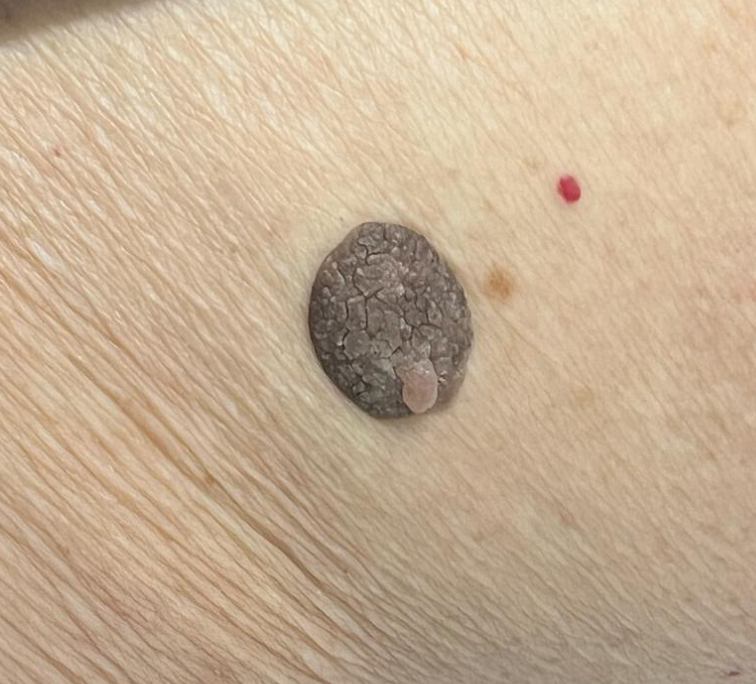 Skin Blemish Removal – HB Academy